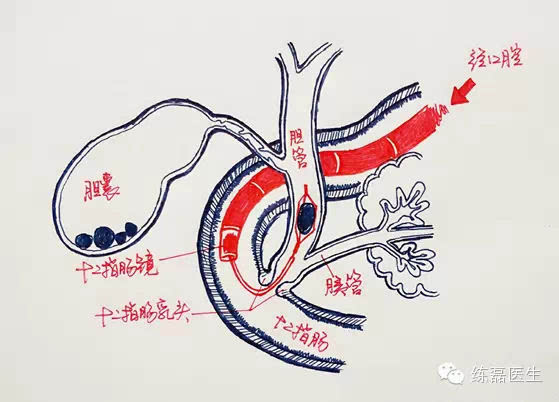 “画”说胆结石那点事，太生动了，秒懂！